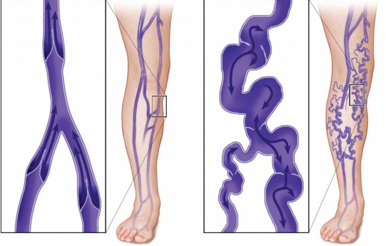 Venų varikozė. Kas Tai? - Biovitup Venų varikozė